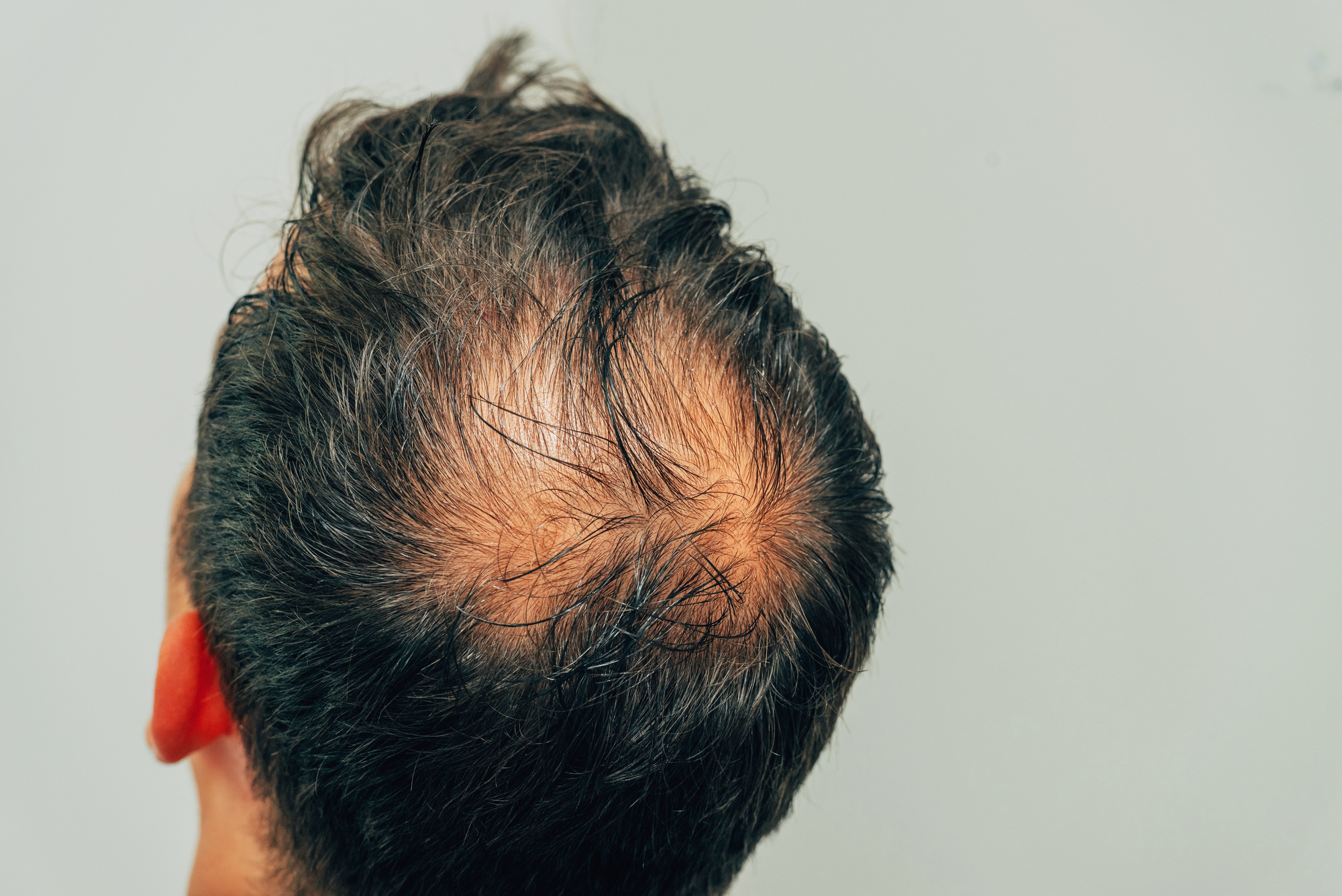 ¿Sufres de calvicie en la coronilla? Causas y Tratamientos - ITC Medical