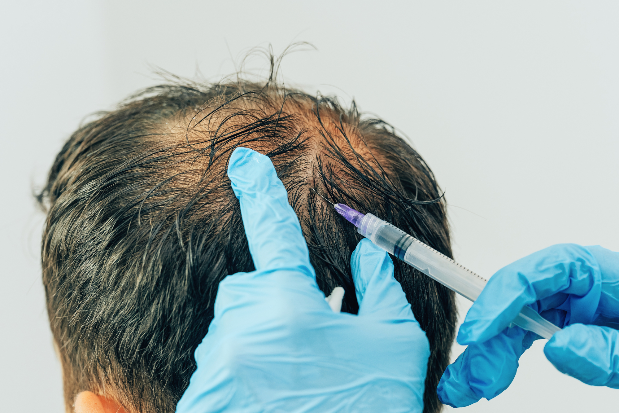 ¿Sufres de calvicie en la coronilla? Causas y Tratamientos - ITC Medical
