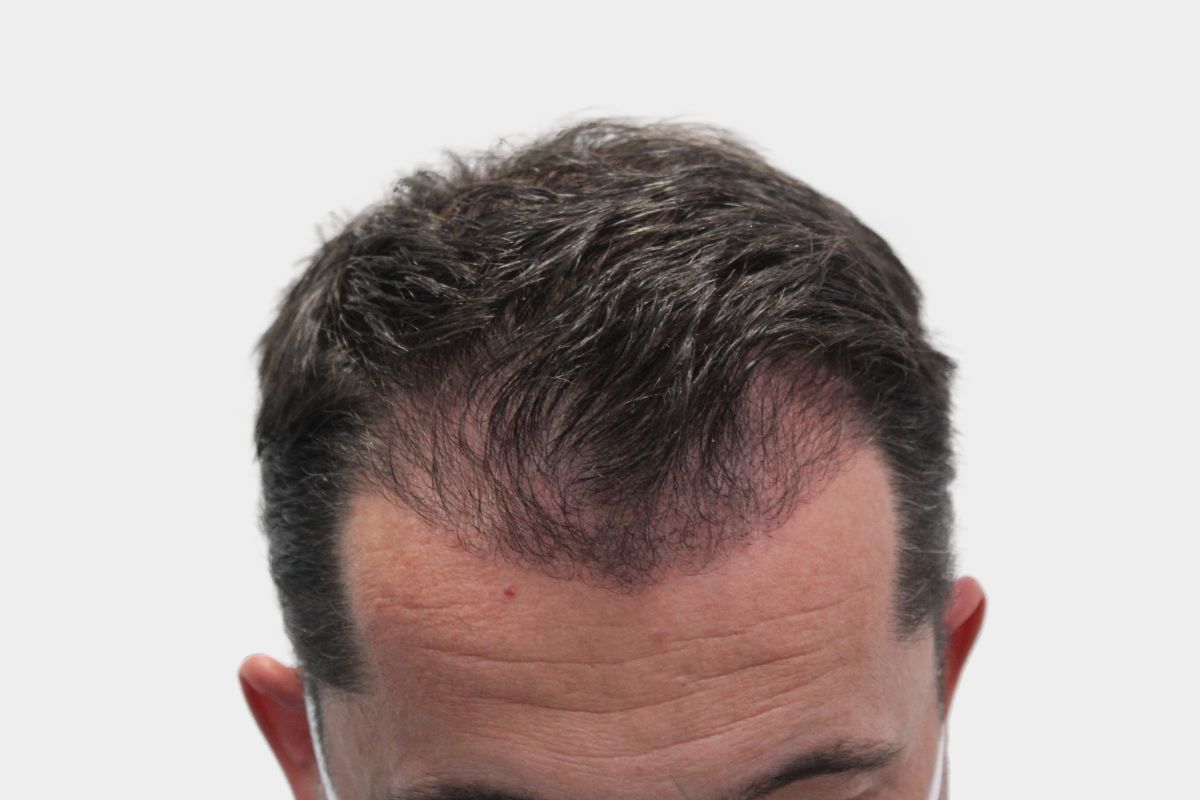 Evolución de un injerto capilar | ITC Medical