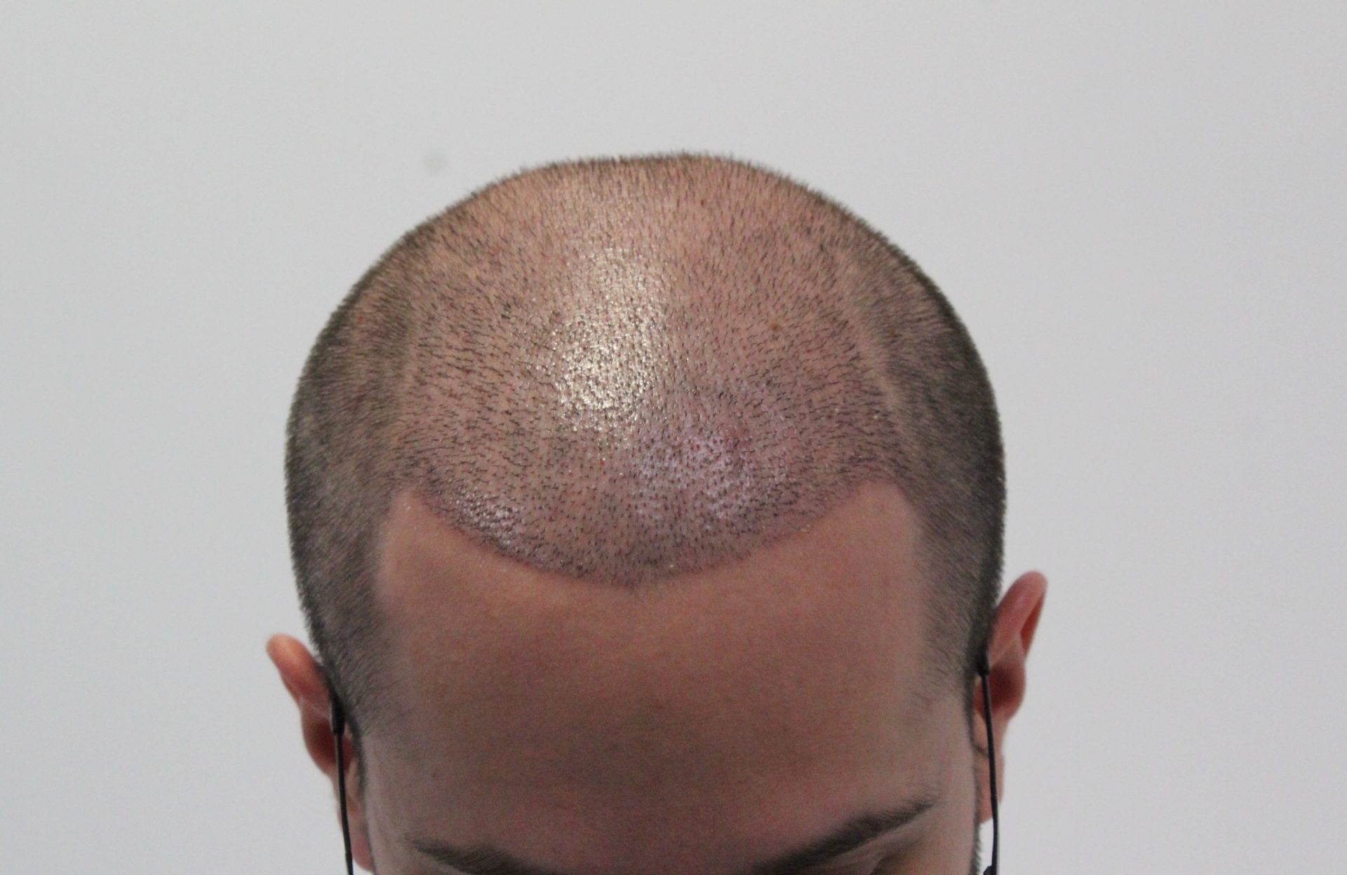 Tratamiento de Costras en Injerto Capilar: Cuidado y Recuperación | ITC ...