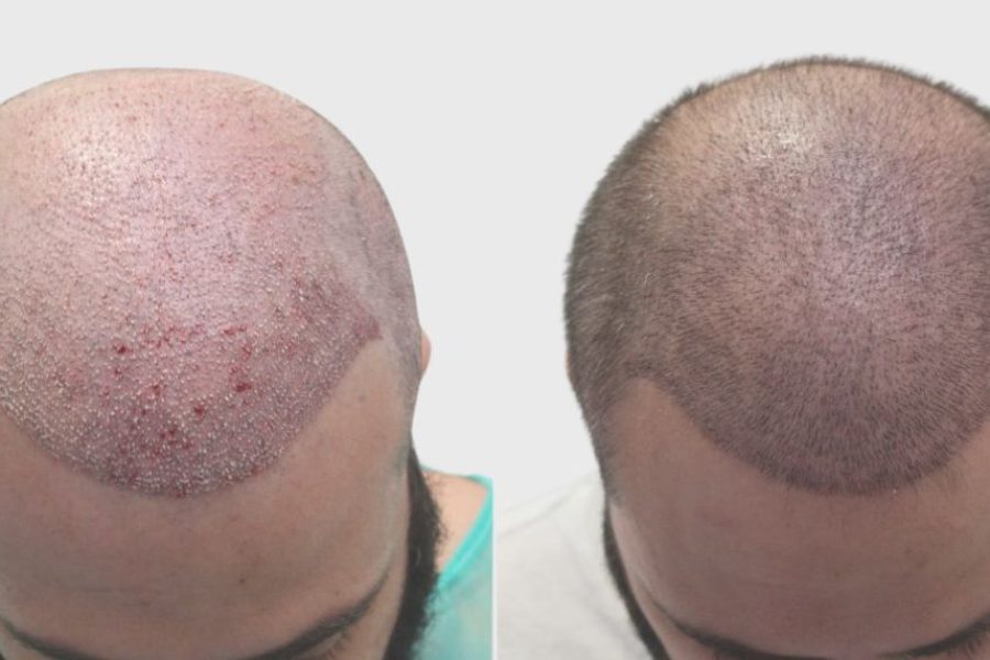 Fases del injerto capilar: guía completa | ITC Medical