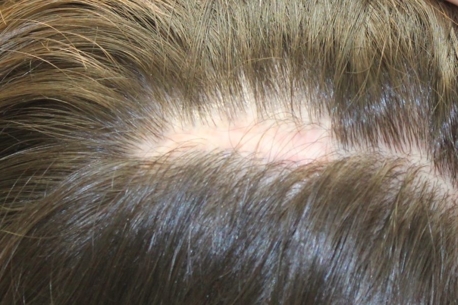 Foliculitis en el Cuero Cabelludo: Síntomas, Causas y Tratamientos ...